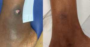 Wound healing in sickle cell leg ulcers – Wounds UK